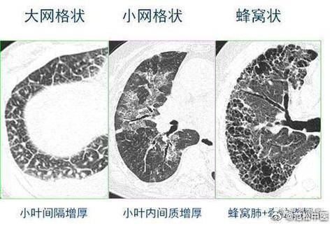 间质性肺病是大病吗图标