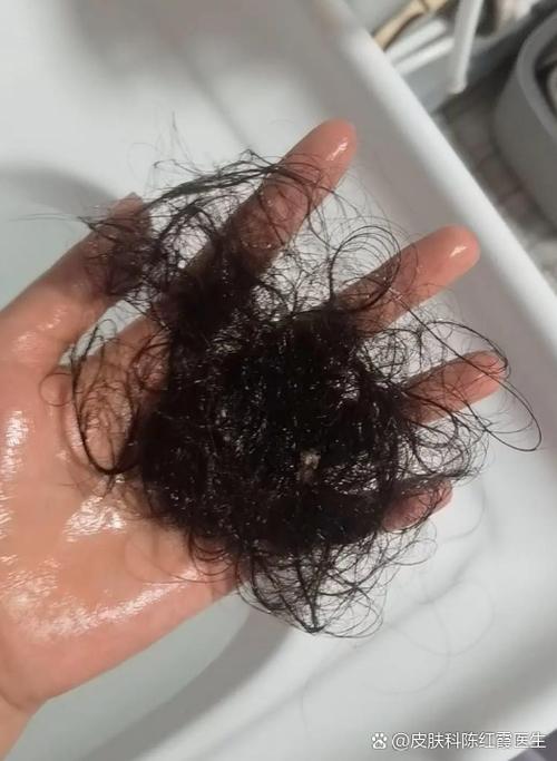 女性严重脱发是怎么回事图标