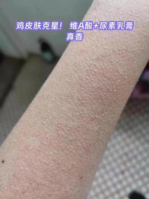 尿素乳膏的副作用和危害