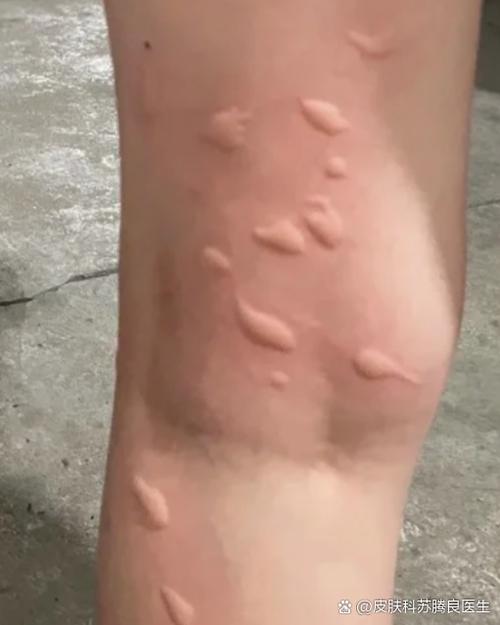 身体痒越抓越痒还起疙瘩怎么回事图标