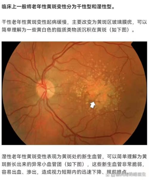 眼睛看东西有水波纹晃动截图