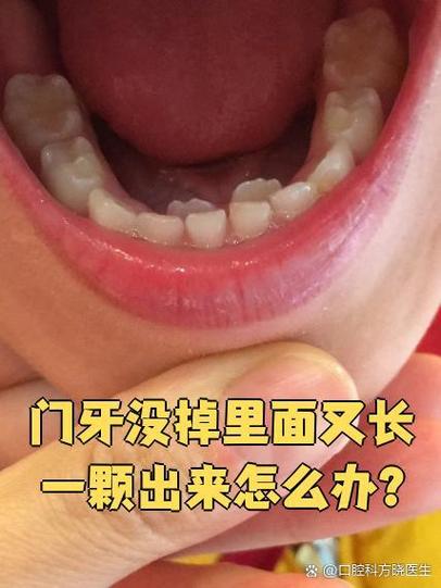 牙齿里面再长一颗牙齿怎么回事图标