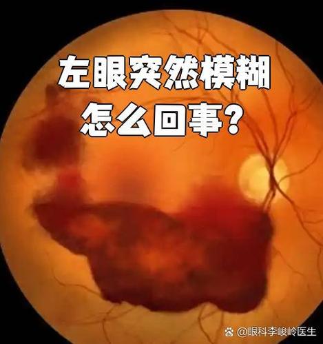 眼睛模糊是什么病图标