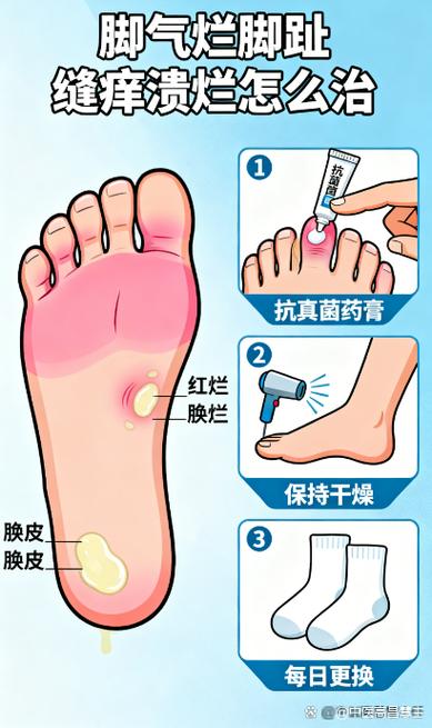脚底深部真菌感染
