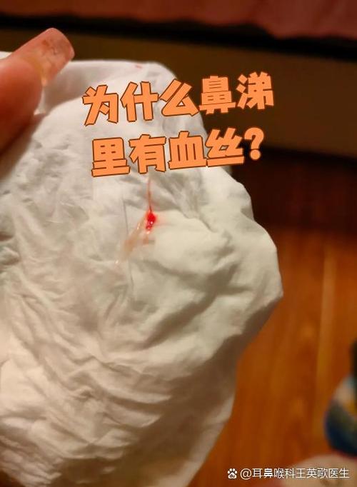 鼻子里面臭还有点堵老流鼻血截图