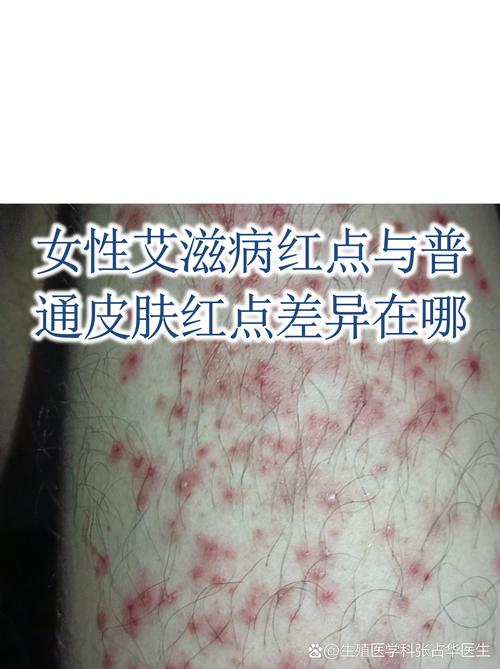 自述是怎样感染艾滋病的图标