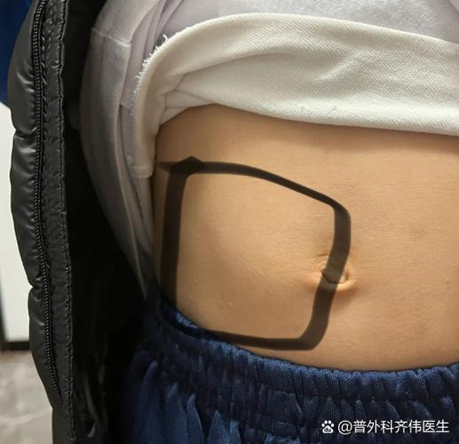 肚脐突出是女孩吗截图