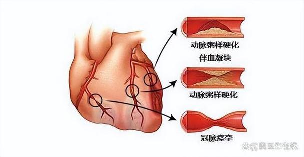 心机血缺血是什么症状