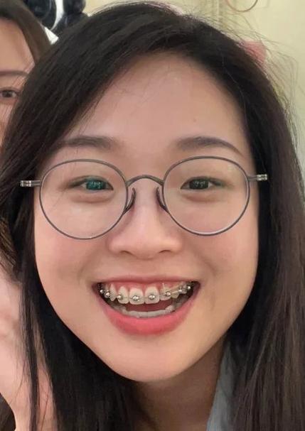 门牙歪了一颗矫正多少钱截图