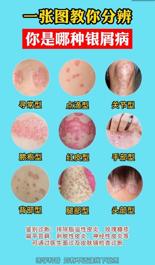 皮肤病 拍图识别截图