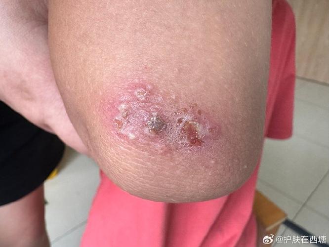 宝宝细菌感染好转的迹象