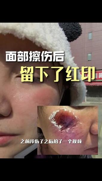 烫伤留下的红印怎么去除截图