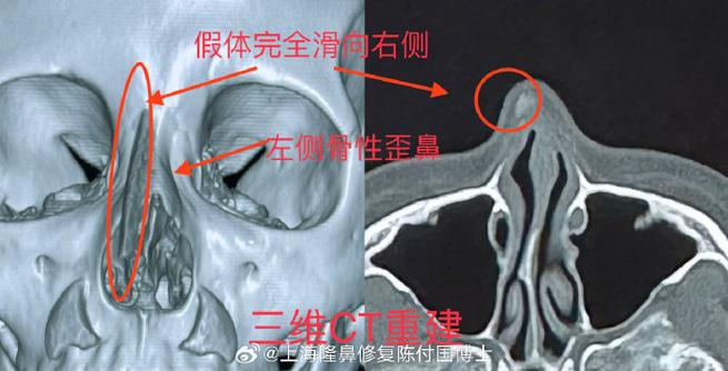 鼻中隔缺损的临床表现图标