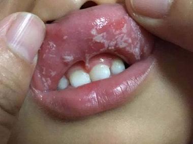小儿口疮图片
