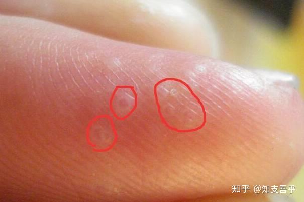 hpv水泡图片