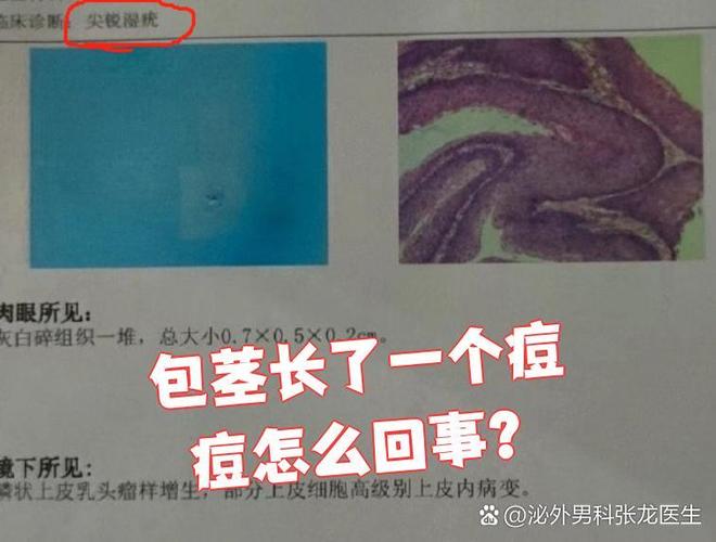 jb上长了一个痘痘图标