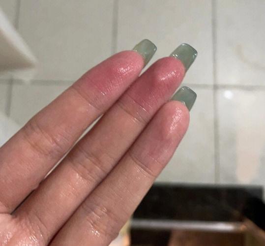 开水烫了没起泡但灼热图标