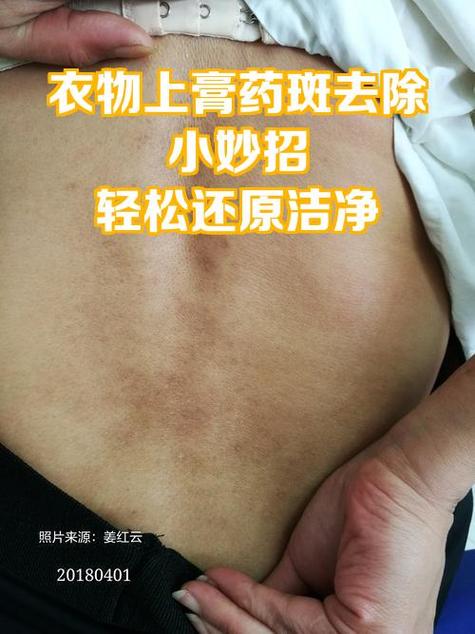 身上沾了膏药怎么去除截图