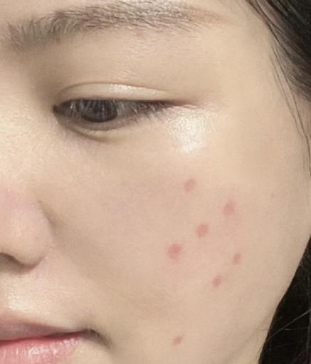 脸上的红印怎么去除图标