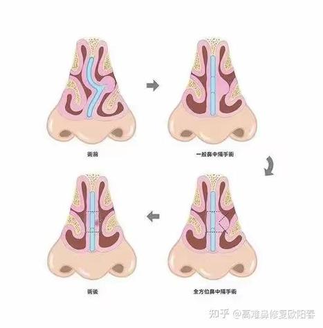 鼻中隔偏曲非要手术吗图标