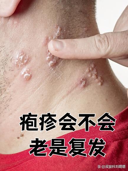 病毒性疱疹怎么引起图标