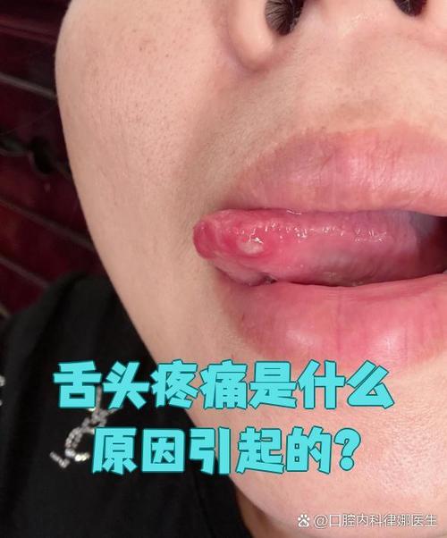 舌头表面有刺痛感图标