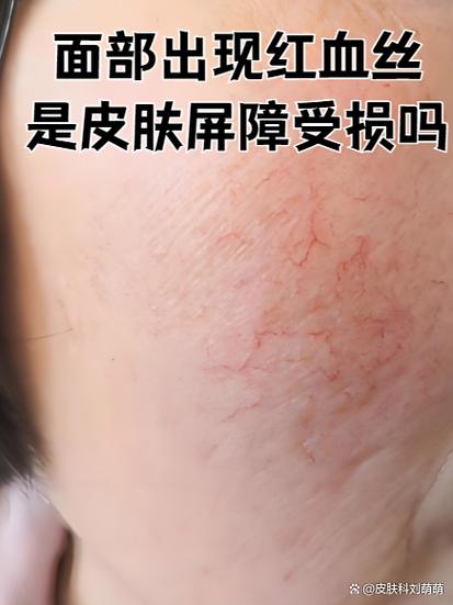 脸上有红血丝是怎么回事