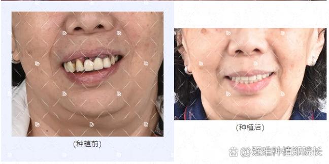 牙齿缺失又不想种牙怎么办图标