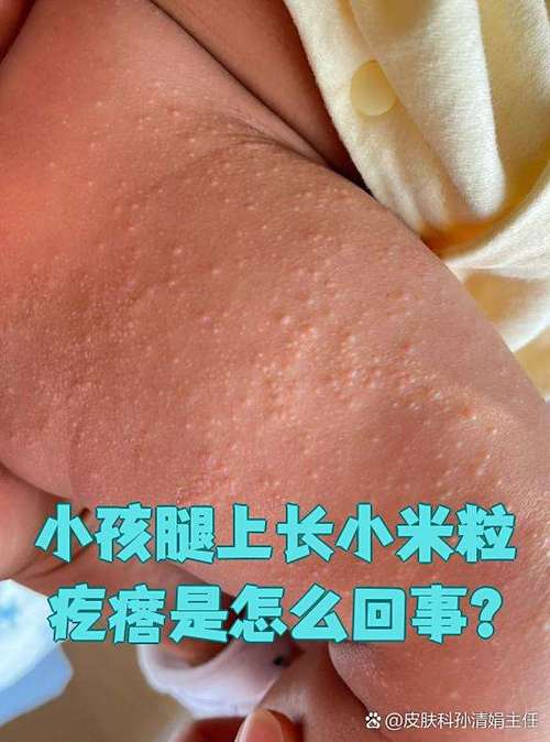 小米粒疙瘩图片截图