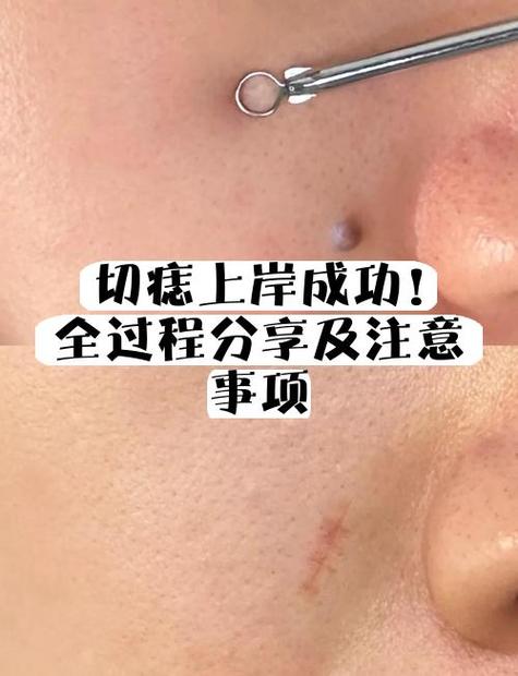 为什么不建议做皮肤镜截图