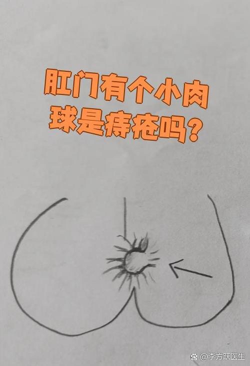 肛门口长个肉疙瘩是什么原因图标