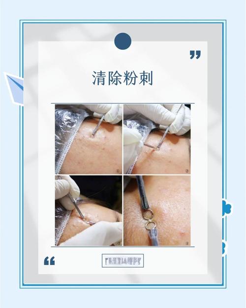 微压怎么删干净截图