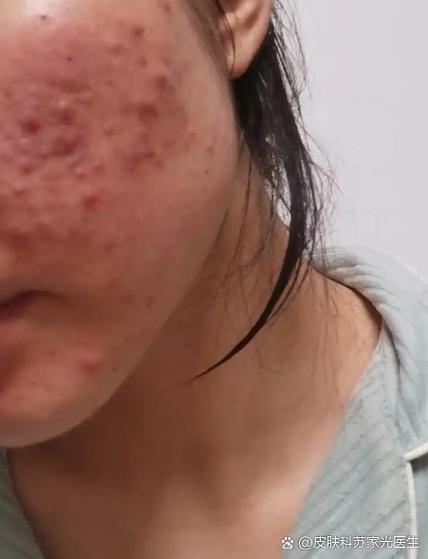 当女生说她长痘痘图标