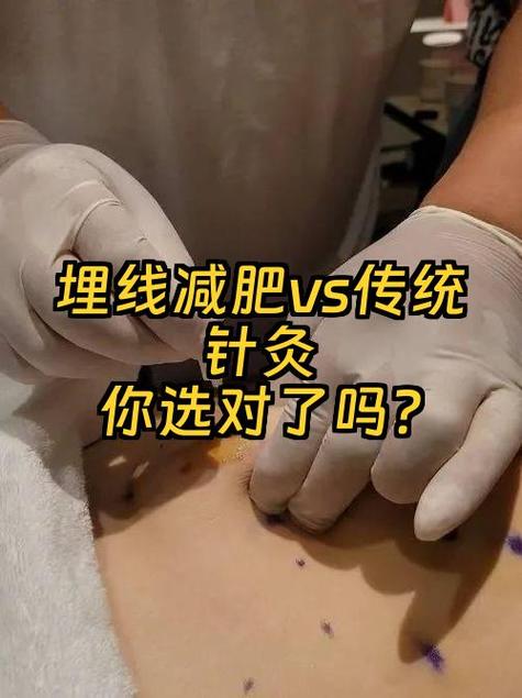 埋线有什么好处和坏处截图