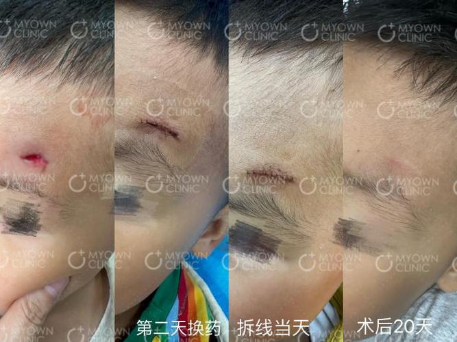 腿上缝了三针几天拆线图标