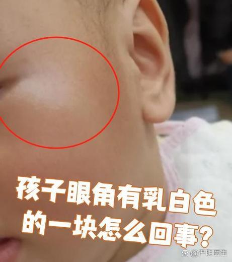 眼角出现白斑什么原因图标