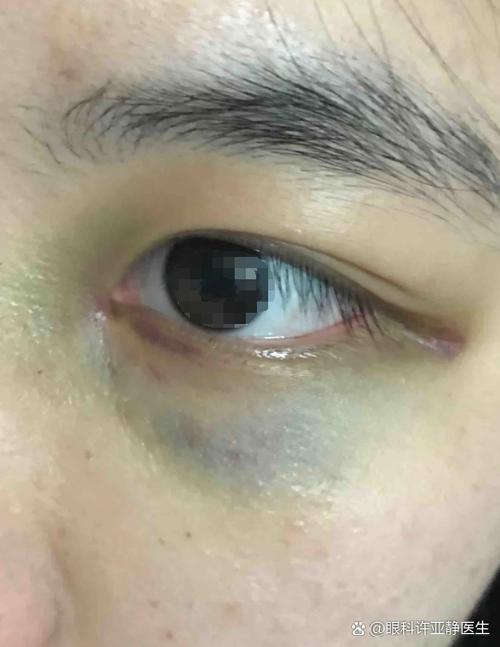 打架眼睛紫了怎么样消快截图