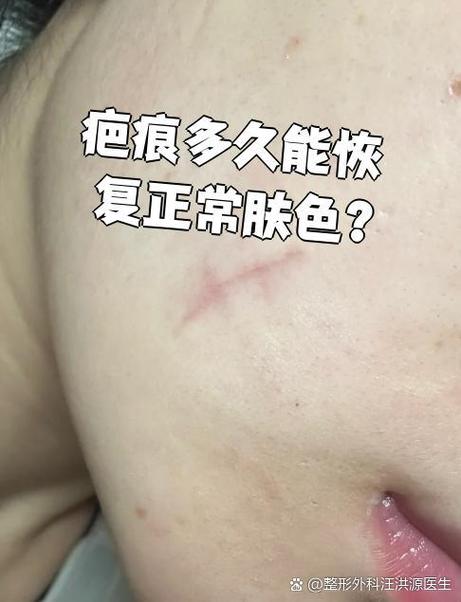 色素疤痕怎样去除能恢复正常颜色吗截图