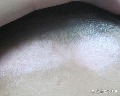 脸上一黑一白怎么回事截图