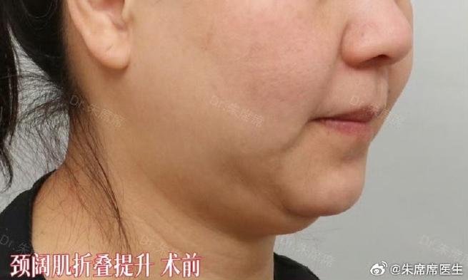 脖子皮肤松弛怎么变紧致缩略图