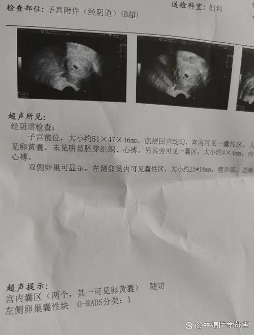 宫内小暗区会是孕囊吗图标