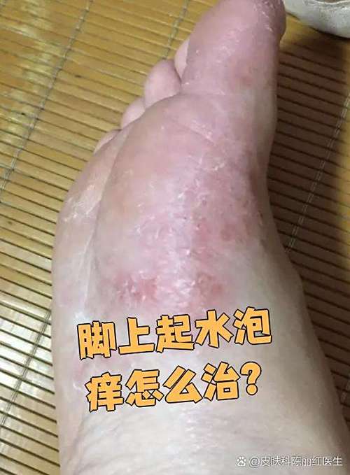 脚丫痒怎么办图标