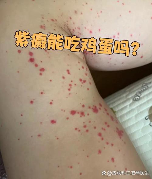紫癜可以吃鸡蛋吗截图