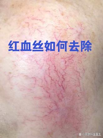 脸上红血丝怎么去除最快方法图标