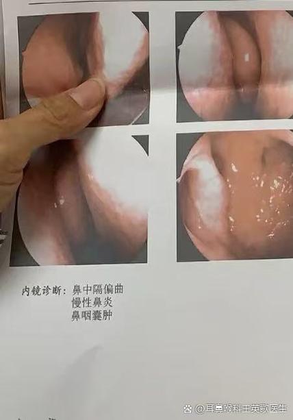 突然流鼻血是什么原因?截图