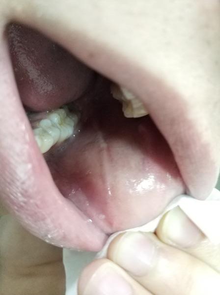 左脸内测长了白线截图