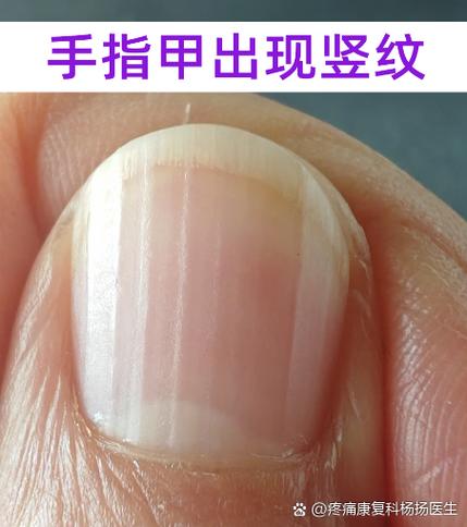 大拇指有竖纹是怎么回事图标