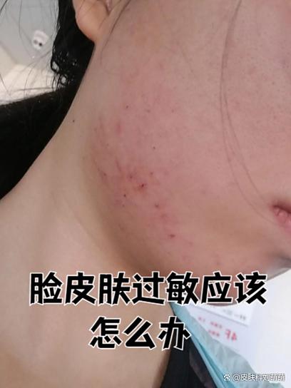 脸部过敏怎么快速消除图标