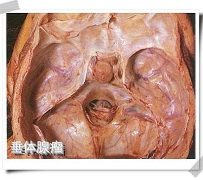 craniopharyngioma