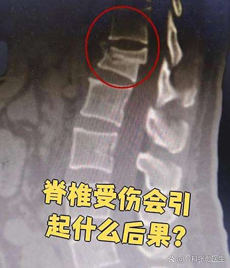 脊椎受伤
